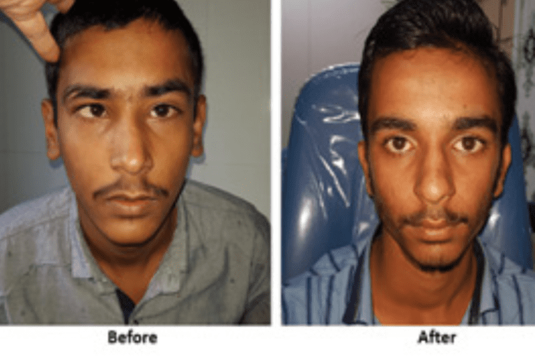 Squint Eye (strabismus)- Causes, Treatments and Surgery in India